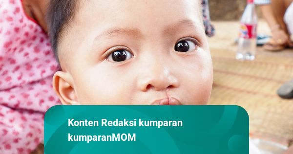 Penyebab dan Cara Cara Bibir Sumbing pada Bayi | kumparan.com Penyebab dan Cara Cara Bibir Sumbing pada Bayi | kumparan.com